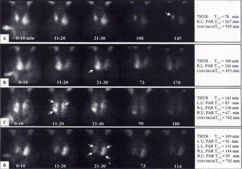 Selected Serial Tetrofosmin Images In Cases With Solitary Parathyroid Download Scientific