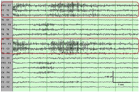 Strategies To Reduce Eeg Qeeg Artifacts