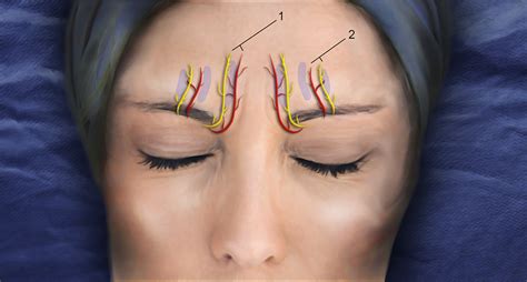 Projection Of The Supratrochlear 1 And Supraorbital 2 Nerves In Download Scientific Projection Of The Supratrochlear 1 And Supraorbital 2 Nerves In Download Scientific
