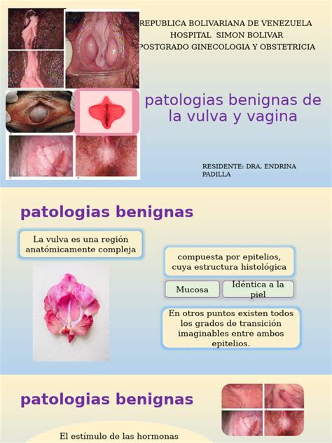 Patologia Benigna De La Vulva Pdf Vagina Neoplasias