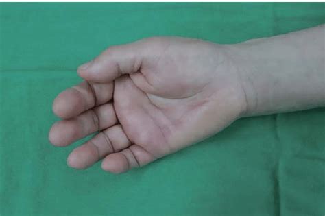 Preoperative Photographs Of The Right Hand Note The Diffuse Swelling