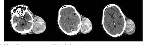 Figure 1 From Giant Temporal Bone Angiosarcoma Case Report And
