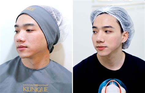 รู้จักเลเซอร์ Pico Clear Enlighten Fx ช่วยเคลียร์ฝ้า กระ จุดด่างดำ รอยสิว รอยสัก ที่มาแรงสุด