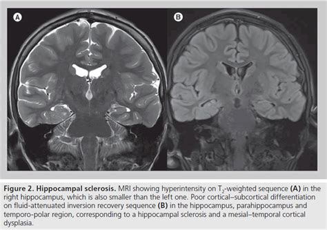 Medial Temporal Lobe Epilepsy