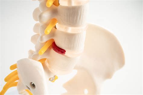 How To Prepare For A Laminectomy Surgery Know Before You Go