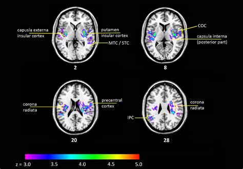Lesion Symptom Inference Csi