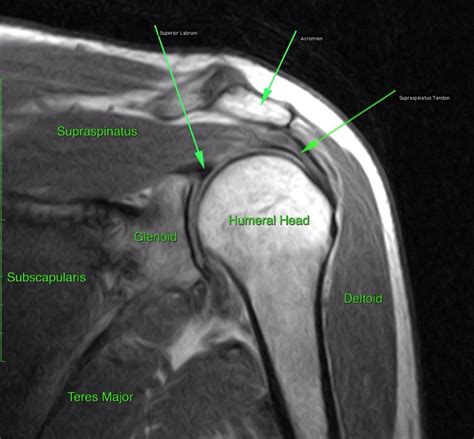 Mri Shoulder Arthrogram Anatomy
