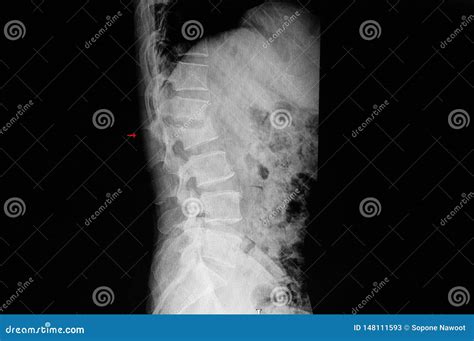 Compression Fracture Of L Spine Royalty Free Stock Photography CartoonDealer Com