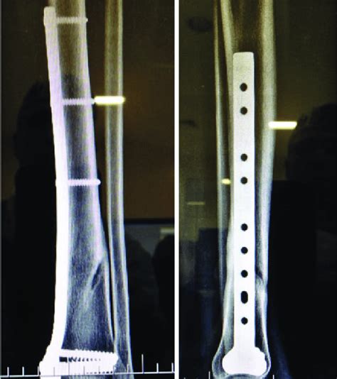 Extra Articular Fracture Of The Distal End Of The Tibia Note Download Scientific Diagram
