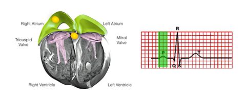 Pacemaker Implantation One Heart Cardiology