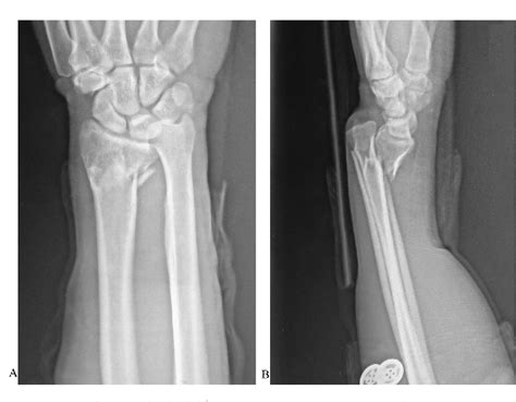 Table 1 From A Comparison Of Minimally Invasive Approach Vs