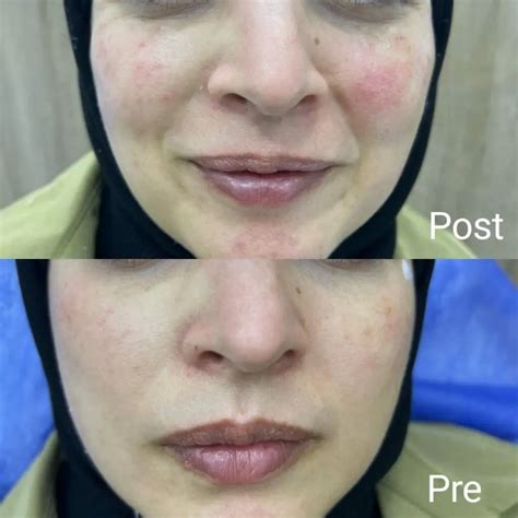 Facial Mesotherapy In Hurghada Book Now Nadara Center