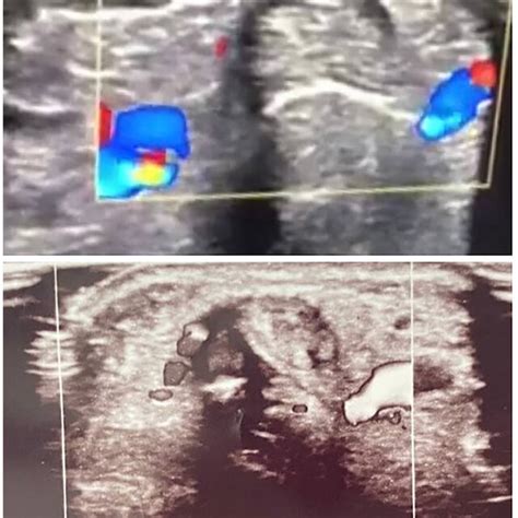 Transverse Scan Of The First Extensor Compartment Of Two Different Download Scientific Diagram