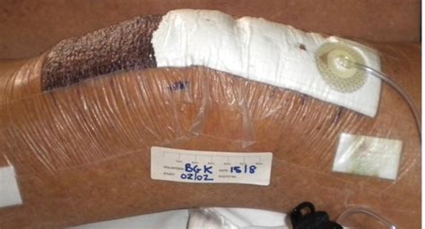 Analysis Shows Effectiveness Of Pico Npwt In Helping To Prevent Surgical Site Complications