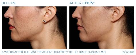 Exion Face Elite Care Clinic