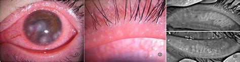 figure s1 basic ocular surface manifestations of bkc patients a