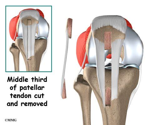 Patellar Tendon Graft Reconstruction Of The Acl