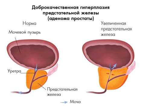 Трансуретральная резекция простаты