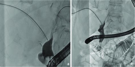 Fluoroscopic Procedure Including Endoscopic Retrograde Download Scientific Diagram