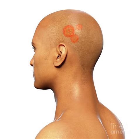 Ringworm Posters By Science Photo Library