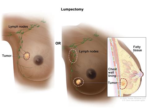 Mastectomy Vs Lumpectomy Understanding Your Surgical Options Meadow