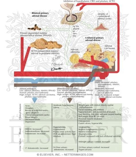 Cushings Syndrome Pathophysiology Continued