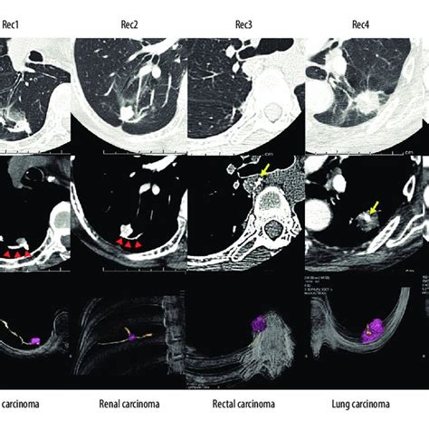 Pdf Pulmonary Staple Stump Granuloma After Segmentectomy Two Case Reports And Comparison With