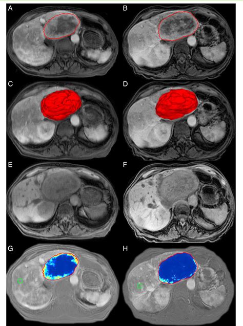 Figure 1 From Renal Cell Carcinoma Metastatic To The Liver Early
