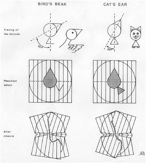 This Figure Shows The Tracing Of The Incision The Resultant Defect