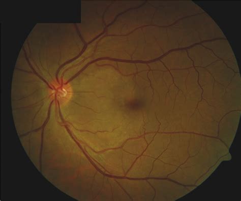 Syphilitic Uveitis Ento Key