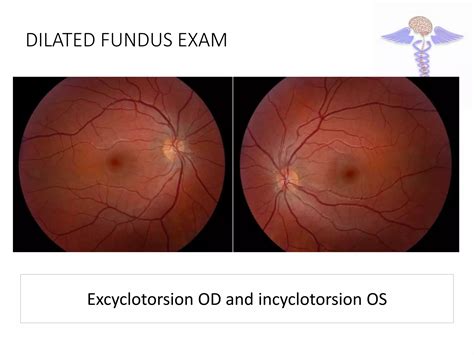 Ocular Tilt Reaction And Skew Deviation Pptx
