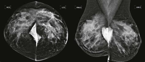 Evaluating Women With Implants Radiology Key