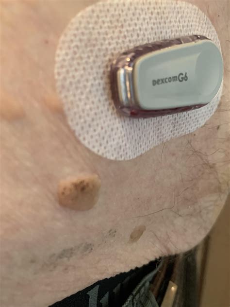 Bloody Dexcom Holdertransmitter Rdexcom