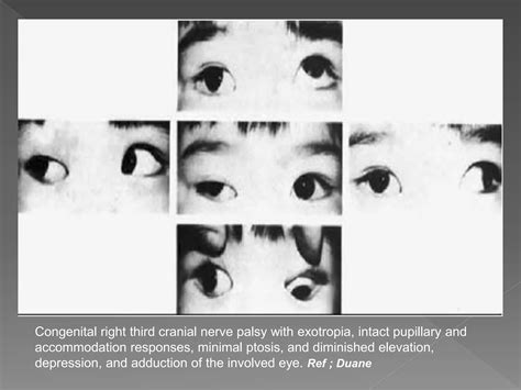 6th Cranial Nerve Palsy Symptoms Hwdb