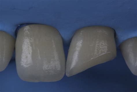 Making Class Iv Restorations Predictable