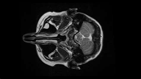 Mri Brain Scan Magnetic Resonance Image Ct Scan Of Human Brain In Dynamic Stock Video Video