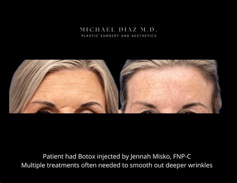 Botox And Fillers Treatments Pictures In Biloxi Ms