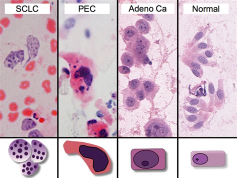Cytology Of The Most Common Tumors Of The Lung Doccheck