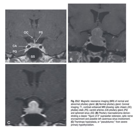 23 Nonfunctioning Pituitary Tumors And Pituitary Incidentalomas