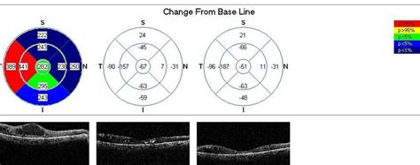 Effect Of Combined Intravitreal Injections Of Bevacizumab And Triamcinolone Acetonide Vs