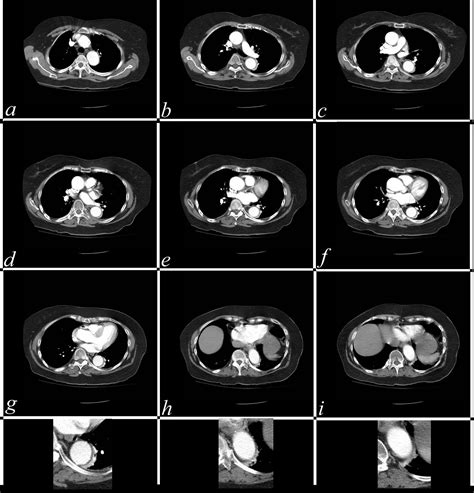 Atelectasis Compressive The Common Vein