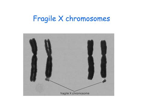 PPT Fragile X Syndrome PowerPoint Presentation Free Download ID 1138412