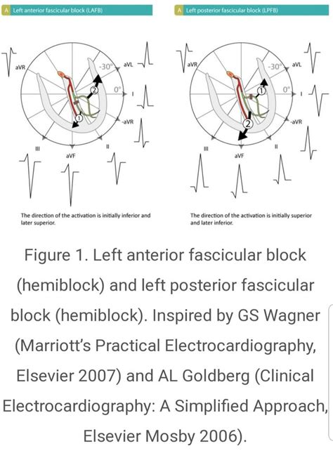 Left Anterior Fascicle
