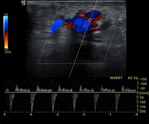 Typical To And Fro Waveform Revealed In The Spectral Analysis