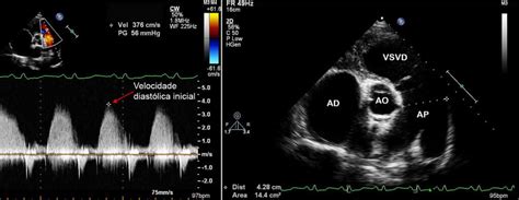 IDENTIFICAÇÃO ECOCARDIOGRÁFICA DA HIPERTENSÃO PULMONAR Blog Ecope