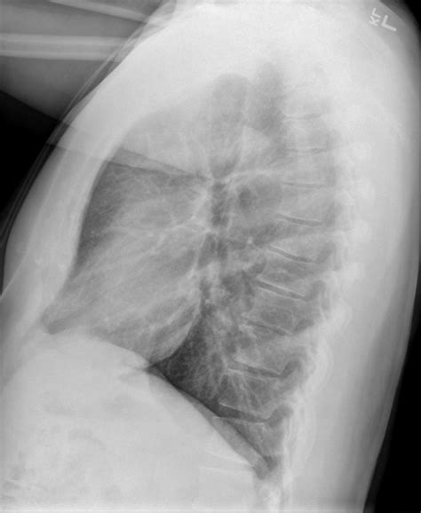Obliterative Bronchiolitis Encyclopedia MDPI