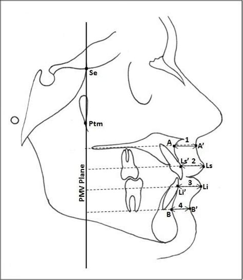 various cephalometric landmarks reference planes and linear parameters