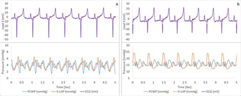 Simultaneous Lap And Pcwp Along With Ecg At Baseline A And After Download Scientific