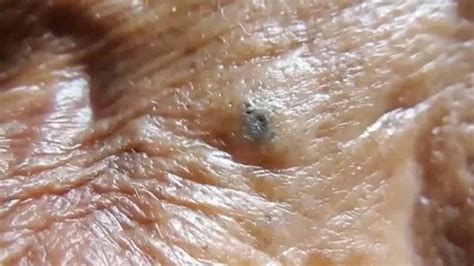 Removal Giant Blackheads From Old Woman 90year Youtube