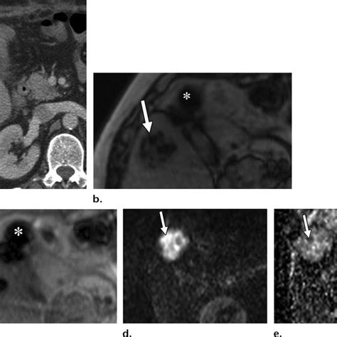 Small Cholangitic Abscesses Mimicking Cysts In A 68 Year Old Woman With Download Scientific